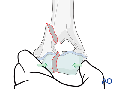 Crossed transcondylar K-wires and antirotational pin for Medial partial ...