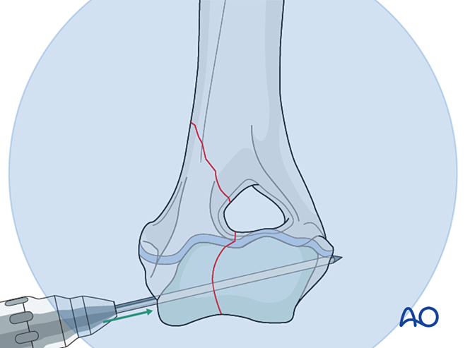 Crossed transcondylar K-wires and antirotational pin for Medial partial ...