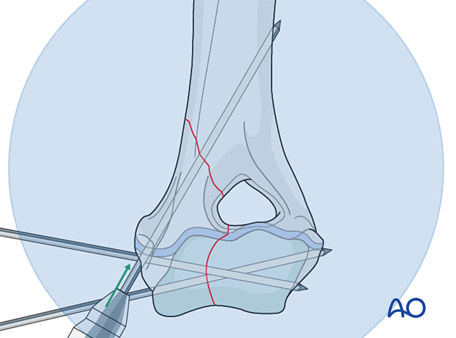 Crossed transcondylar K-wires and antirotational pin for Medial partial ...