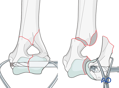 Transcondylar screw and bilateral plating for Simple complete articular ...