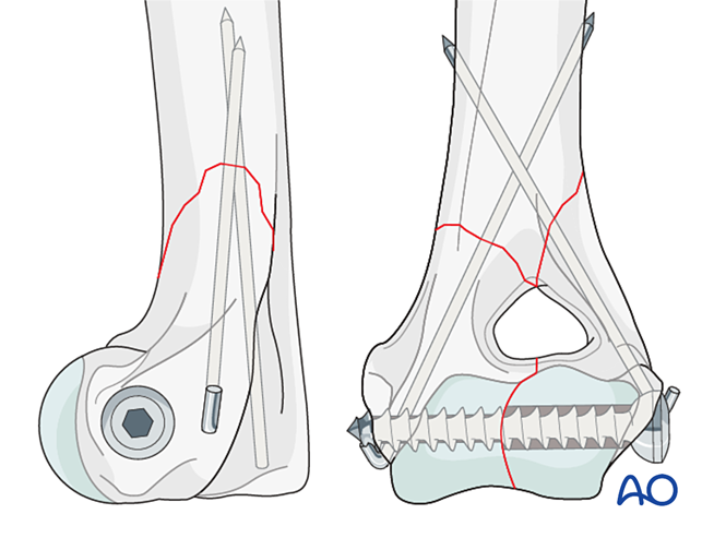 Transcondylar screw and bilateral antirotational pins for Simple ...