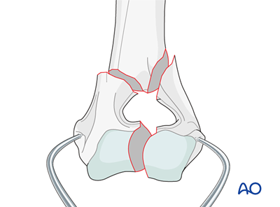 Transcondylar screw and bilateral plating for Simple complete articular ...