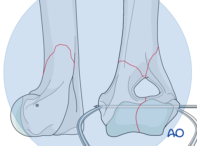 Transcondylar screw and bilateral plating for Simple complete articular ...
