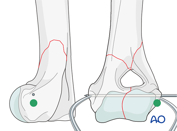 Transcondylar screw and bilateral plating for Simple complete articular ...