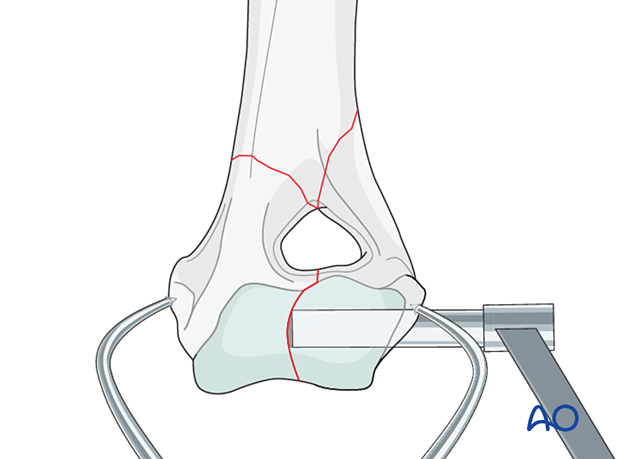 Transcondylar screw and bilateral plating for Simple complete articular ...