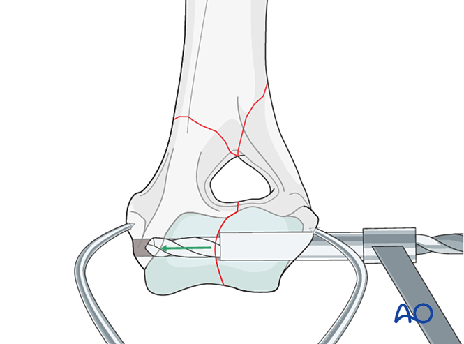 Transcondylar screw and bilateral plating for Simple complete articular ...