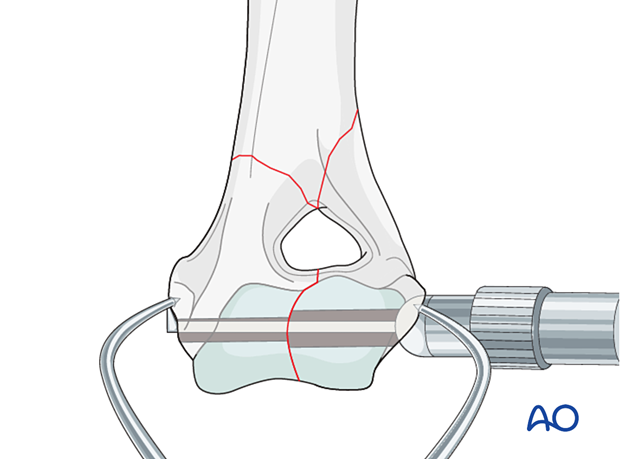 Transcondylar screw and bilateral antirotational pins for Simple ...