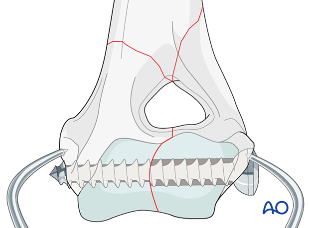 Transcondylar screw and bilateral plating for Simple complete articular ...