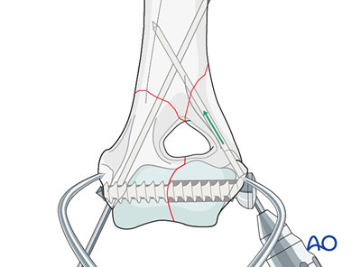 Transcondylar screw and bilateral antirotational pins for Simple ...
