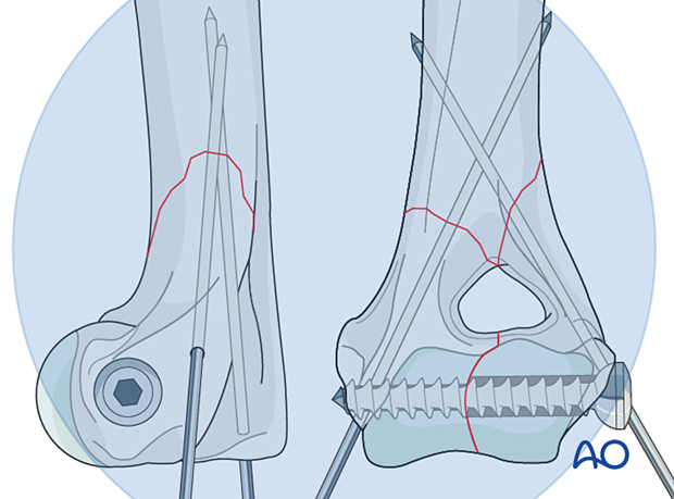 Transcondylar screw and bilateral antirotational pins for Simple ...