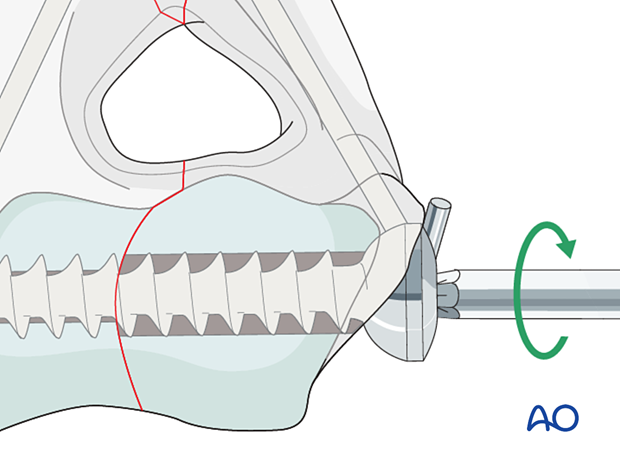 Transcondylar screw and bilateral antirotational pins for Simple ...