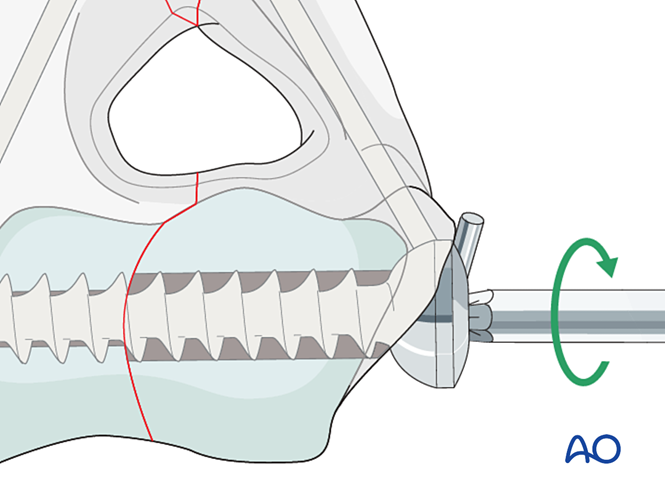 Transcondylar screw and bilateral antirotational pins for Simple ...