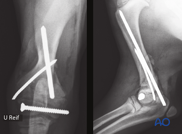 Transcondylar screw and bilateral antirotational pins for Simple ...