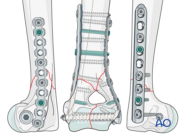 Transcondylar screw and bilateral plating for Simple complete articular ...