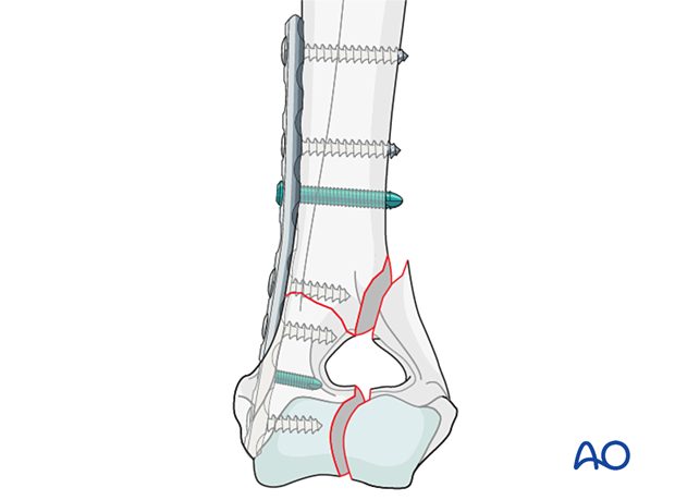 Transcondylar screw and bilateral plating for Simple complete articular ...