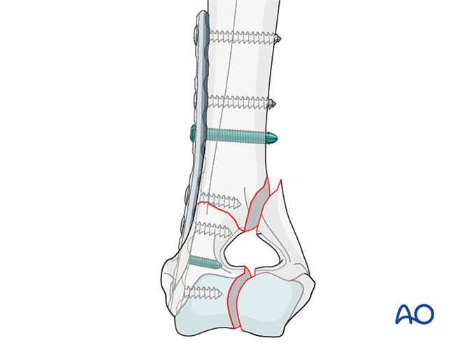 Transcondylar screw and bilateral plating for Simple complete articular ...
