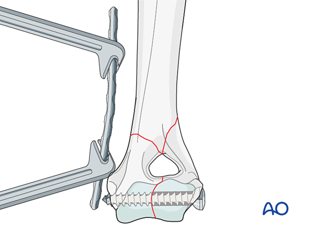 Transcondylar screw and bilateral plating for Simple complete articular ...