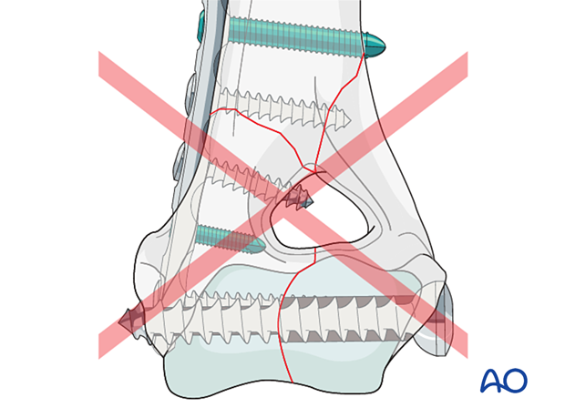 Transcondylar screw and bilateral plating for Simple complete articular ...