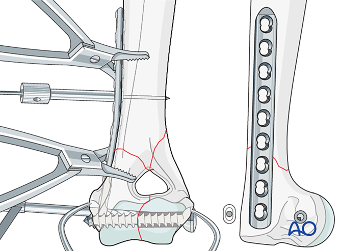 Transcondylar screw and bilateral plating for Simple complete articular ...
