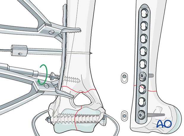 Transcondylar screw and bilateral plating for Simple complete articular ...