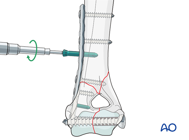 Transcondylar screw and bilateral plating for Simple complete articular ...