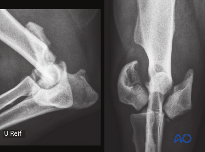Transcondylar screw and bilateral plating for Simple complete articular ...