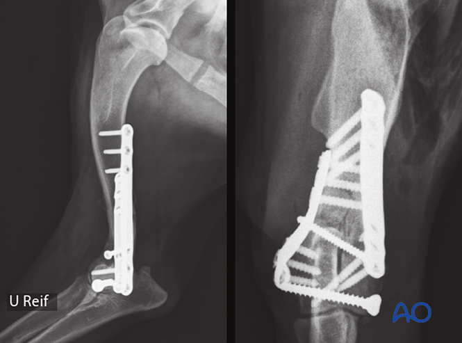 Transcondylar screw and bilateral plating for Simple complete articular ...