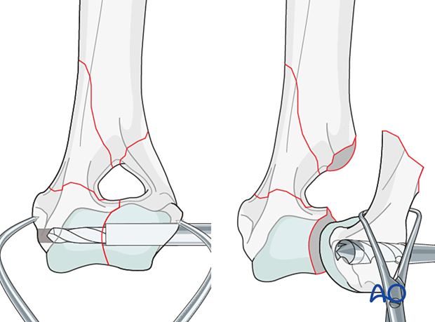 Transcondylar screw and bilateral plating for Simple complete articular ...