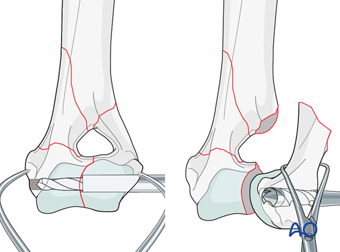 Transcondylar screw and bilateral plating for Simple complete articular ...