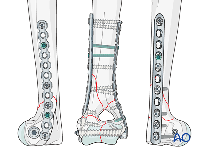 Transcondylar screw and bilateral plating for Simple complete articular ...