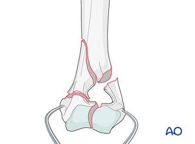 Transcondylar screw and bilateral plating for Simple complete articular ...