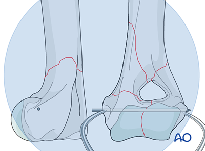 Transcondylar screw and bilateral plating for Simple complete articular ...