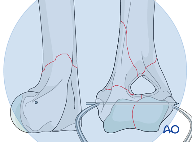 Transcondylar screw and bilateral plating for Simple complete articular ...