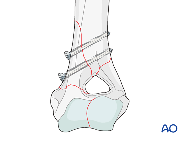 Transcondylar screw and bilateral plating for Simple complete articular ...