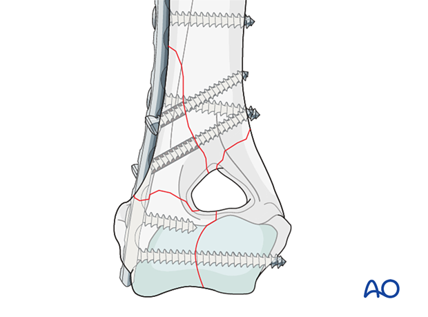 Transcondylar screw and bilateral plating for Simple complete articular ...