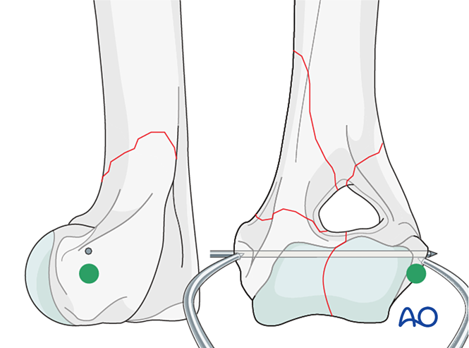 Transcondylar screw and bilateral plating for Simple complete articular ...