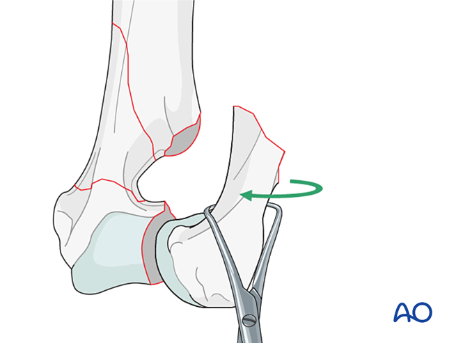 Transcondylar screw and bilateral plating for Simple complete articular ...