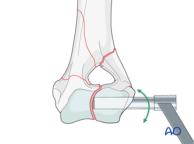 Transcondylar screw and bilateral plating for Simple complete articular ...