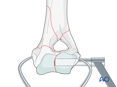 Transcondylar screw and bilateral plating for Simple complete articular ...