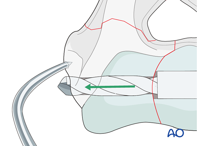 Transcondylar screw and bilateral plating for Simple complete articular ...