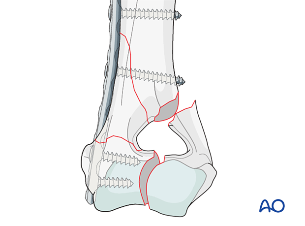 Transcondylar screw and bilateral plating for Simple complete articular ...