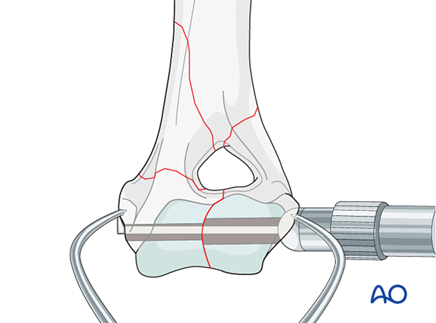 Transcondylar screw and bilateral plating for Simple complete articular ...