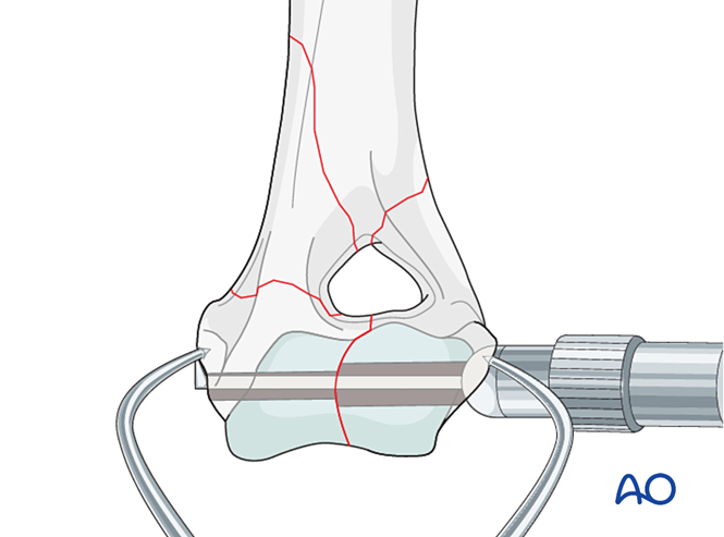 Transcondylar screw and bilateral plating for Simple complete articular ...