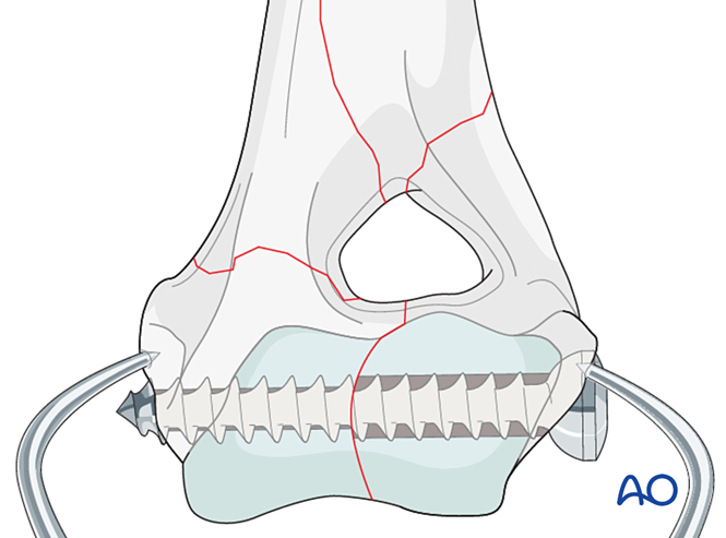 Transcondylar screw and bilateral plating for Simple complete articular ...