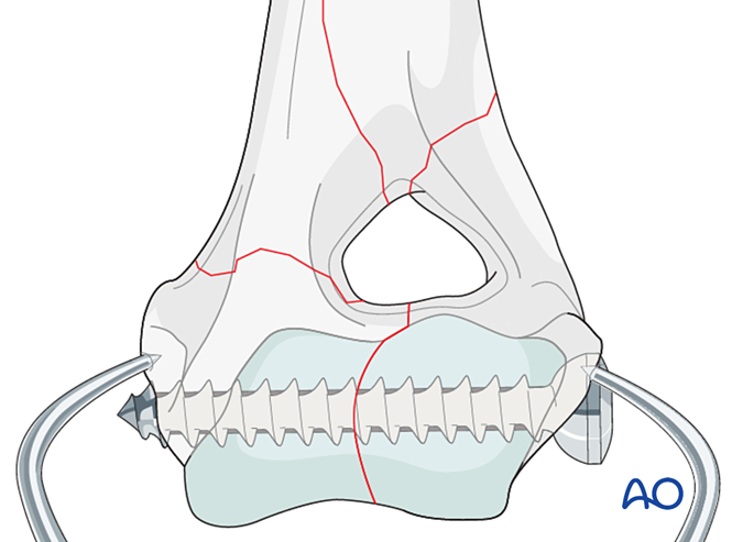Transcondylar screw and bilateral plating for Simple complete articular ...