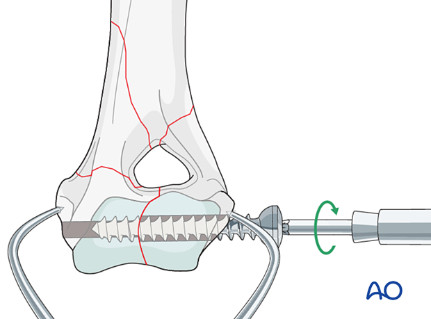 Transcondylar screw and bilateral plating for Simple complete articular ...
