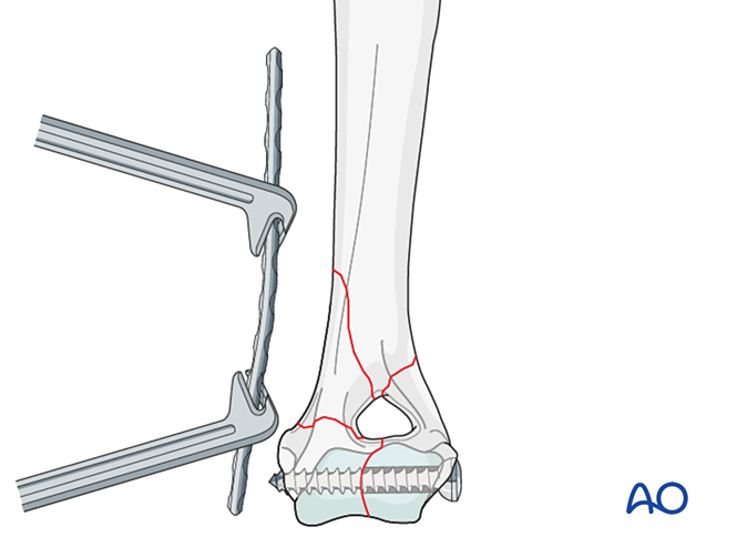 Transcondylar screw and bilateral plating for Simple complete articular ...