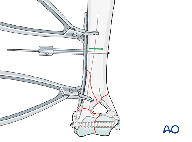Transcondylar screw and bilateral plating for Simple complete articular ...