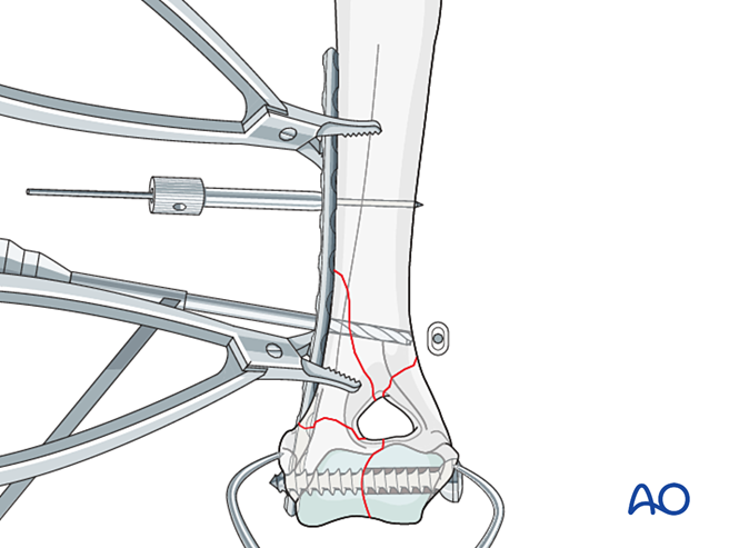 Transcondylar screw and bilateral plating for Simple complete articular ...