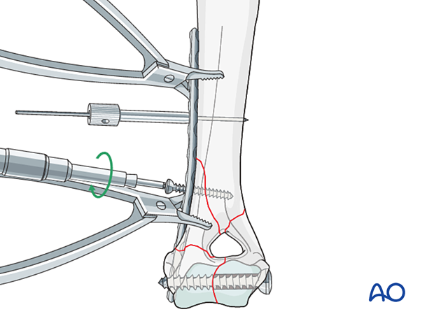 Transcondylar screw and bilateral plating for Simple complete articular ...